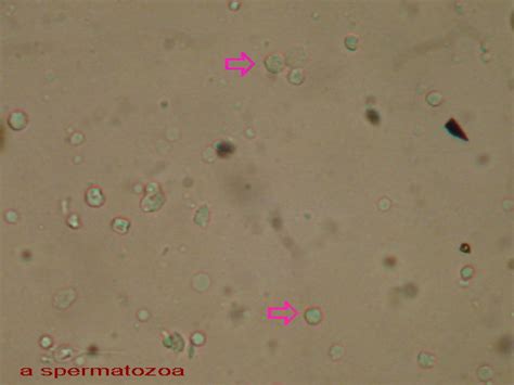Photomicrographs Of Prostatic Fluid Given What Are The Arrow Marked