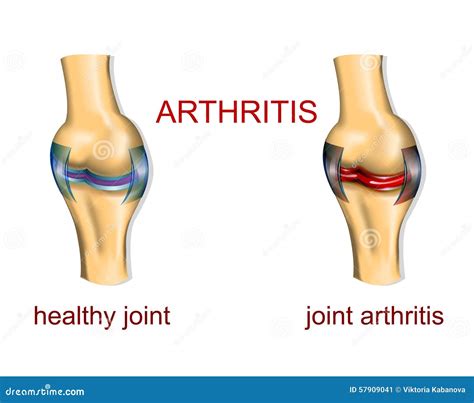 Joint Arthritis Stock Vector Illustration Of Articulation 57909041