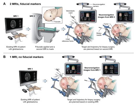 Reducing Institutional Imaging Costs For Stereotactic Brain Biopsy