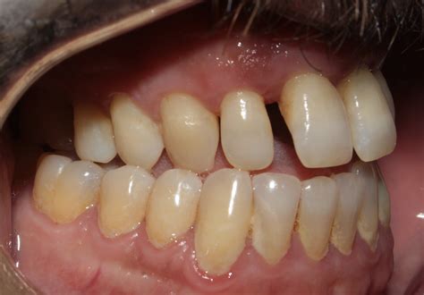 Case Gallery Clearcorrect