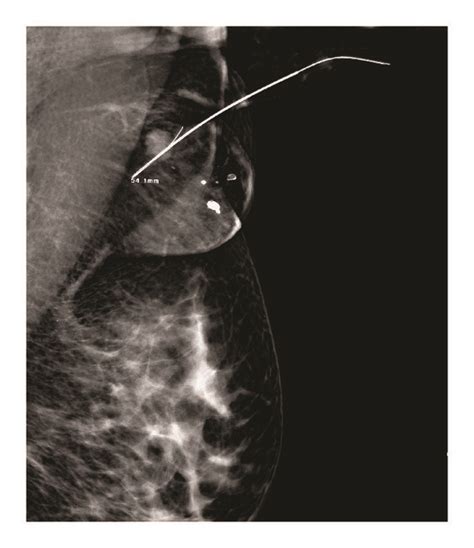 Wide Needle Localized Excision A With Intraoperative Radiography Of Download Scientific
