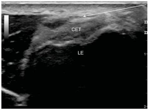 Common Extensor Tendon Injection Wikism Sports Medicine Wiki