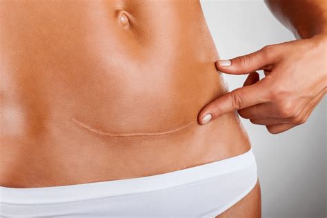 Can You Ever Get Rid Of C Section Pouch Live Core Strong