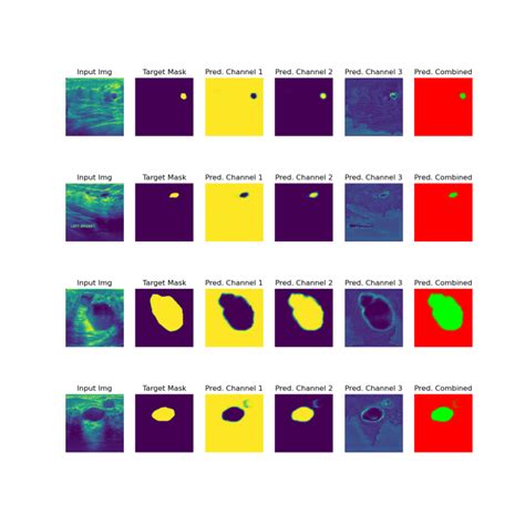 breast ultrasound segmentation using an u net implemented in tensorflow