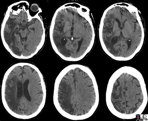 Chronic Infarction Brain The Common Vein