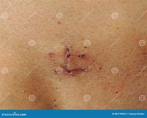 Inguinal Hernia Laparoscopic Surgery To Remove An Inguinal Hernia Modern Surgery Saving A