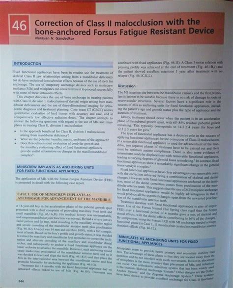 Pdf Correction Of Class Ii Malocclusion With The Bone Anchored Forsus