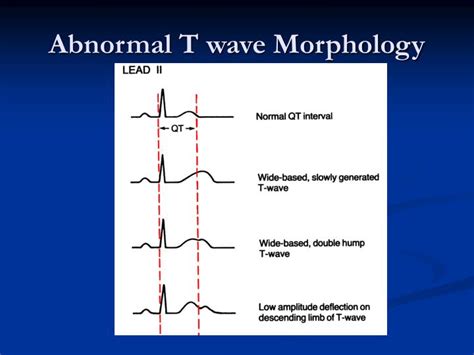 PPT Long QT Syndrome PowerPoint Presentation ID