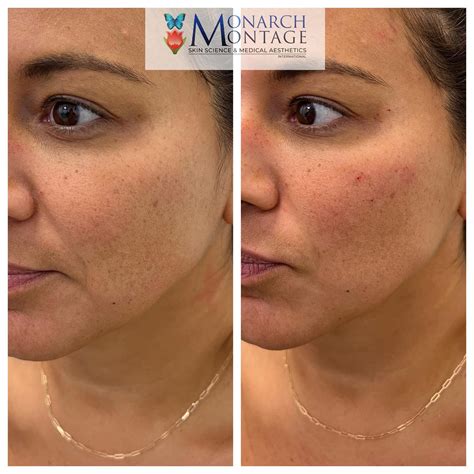 Before And After Gallery Monarch Montage New York Medspa