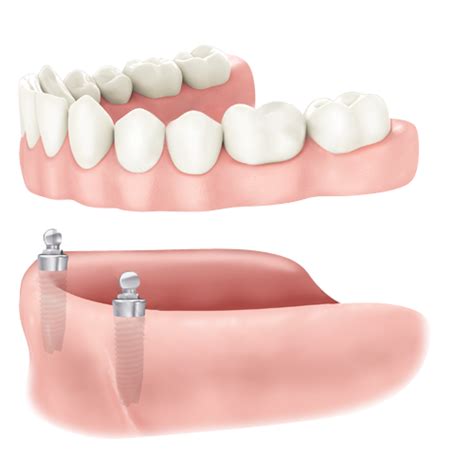 Implant Supported Removable Denture At Garrett Kirk Blog