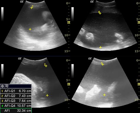 Amniotic Fluid Index Chart New Health Advisor