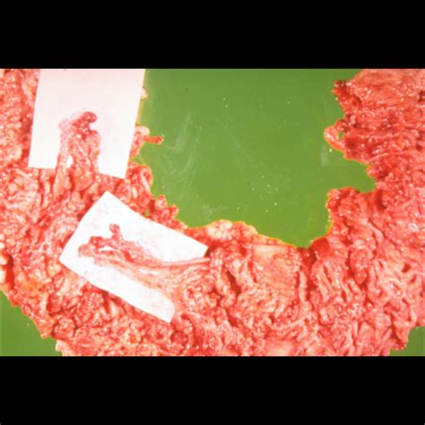 Pediatric Ulcerative Colitis Pediatric Radiology Reference Article Pediatric Imaging