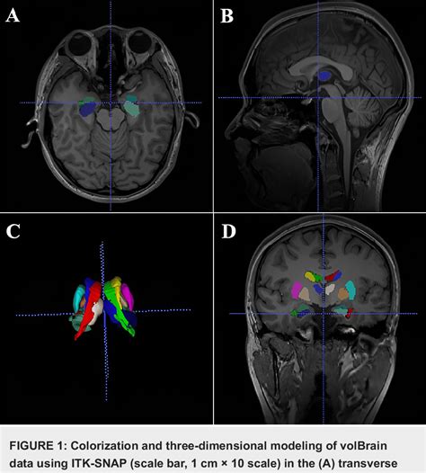 Figure 1 From Volumetric And Asymmetric Index Analysis Of Subcortical Structures In Multiple