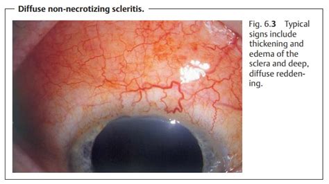 Scleritis