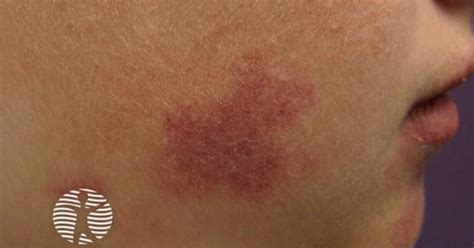 Vascular Malformation Image