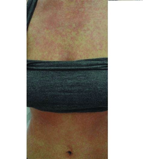 Diffuse Exanthematous Macular Rash On The Trunk Download Scientific Diagram