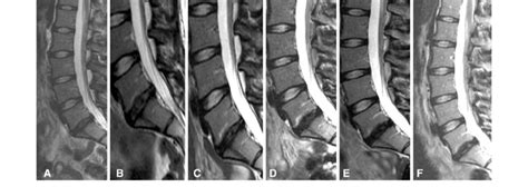 28 Years Old Woman Undergoing Discectomy In Level L5 S1 The 60 Month