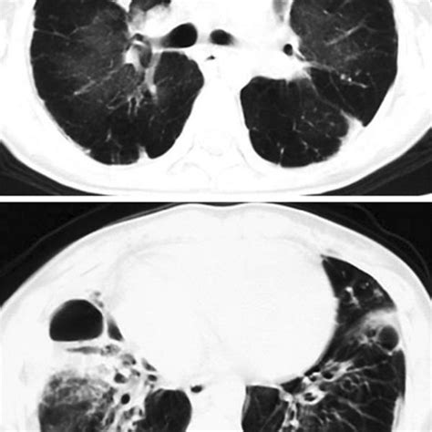 Chest Ct Scan Revealed A Widespread Mosaic Pattern With Air Trapping