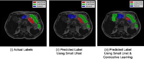 Figure 1 From Gastro Intestinal Tract Segmentation Using Multi Task