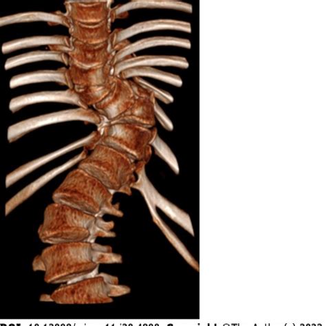 Three Dimensional Computed Tomography Reconstruction Of The Download Scientific Diagram