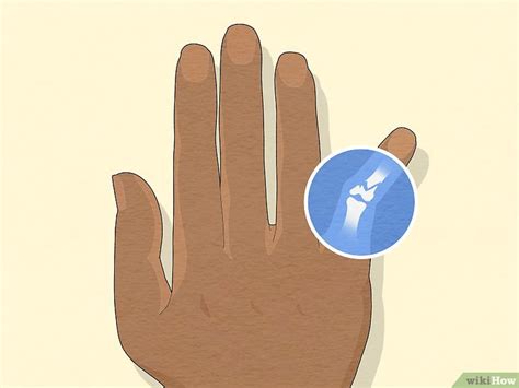 How To Determine If A Finger Is Broken Symptoms More