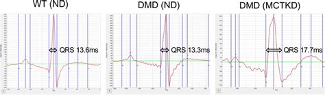 Representative Electrocardiogram Images A Significant Prolongation Of