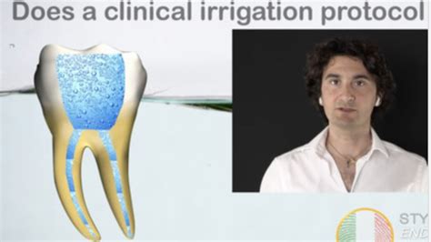 Does A Irrigation Protocol Truly Exist Pop Dentistry