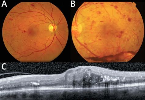 Macular Edema