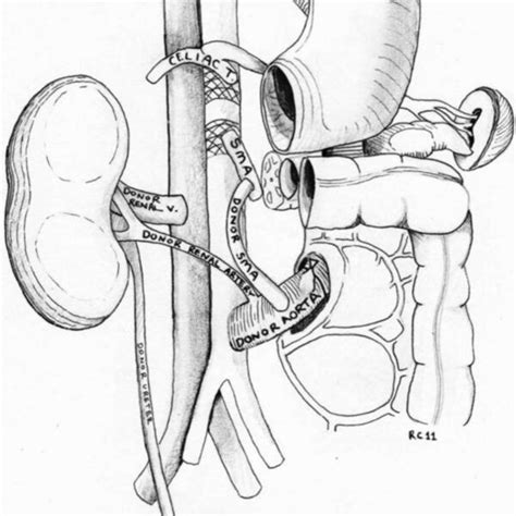Illustration Depicting Aorto Aortic Bypass Renal Transplantation And Download Scientific