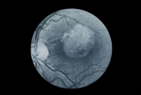 Cryptococcal Chorioretinitis Retina Image Bank