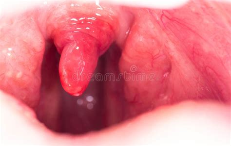 Inflammation Of The Uvula In The Oral Cavity Due To Infection And Virus