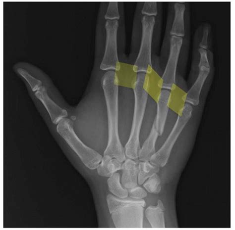Metacarpal Head