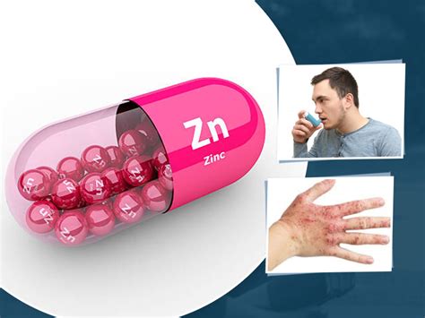 Zinc Supplements How Can Zinc Reduce Allergies Onlymyhealth