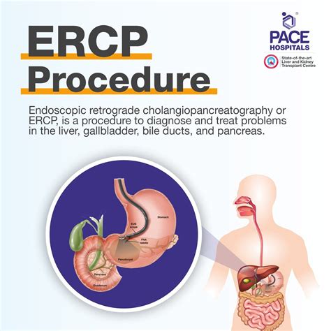 ERCP Procedure In Hyderabad Indications Surgery Cost And Treatment