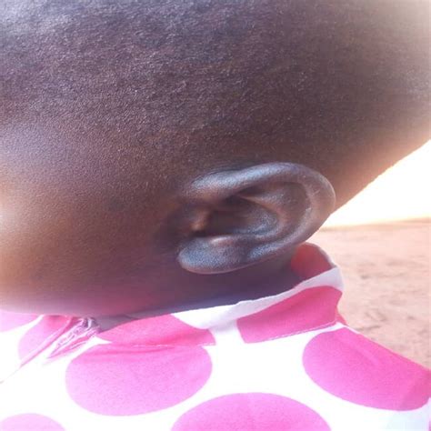 Showing Complete Healing Of The External Ear After 6‐mo Follow Up