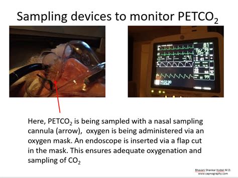How Do You Use Capnography During Sedation Bhavani Kodalis Algorithm Capnography