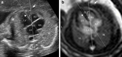 Fetal Cardiac Measurements In A 23 Week Normal Female Fetus A Fetal Download Scientific