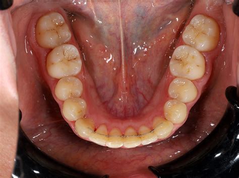 Case Gallery Clearcorrect