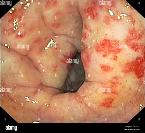 Proctitis Following Radiotherapy Treatment Endoscopic View Of Ulceration And Inflammation