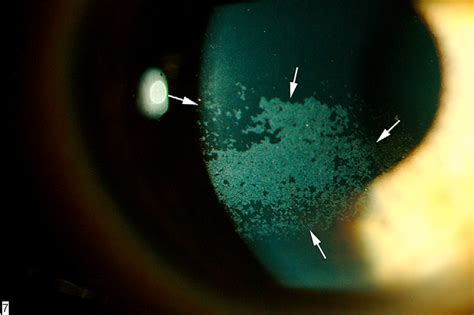 Punctate Epithelial Erosion