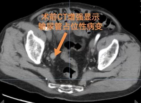 78岁老人血尿就医，竟被查出这种癌！专家微创手术巧解难题