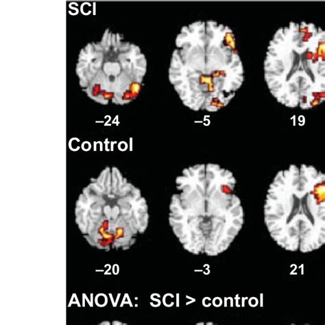 Group Activation Maps During Encoding In Subjective Cognitive Decline