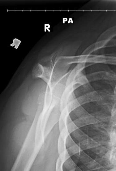 Nonoperative Management Of A Displaced Cartilaginous Avulsion Fracture