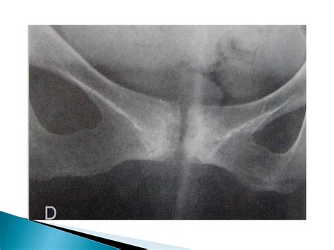 Hyperparathyroidism Ppt