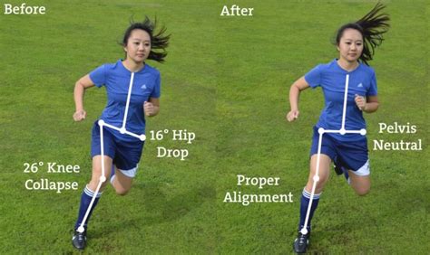 Acl Prevention Programs Can We Do More Sports Medicine Review