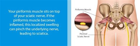 What Is Piriformis Syndrome Nj Spine And Orthopedic