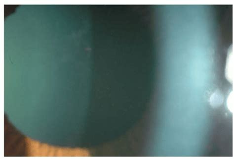 Anterior Uveitis Hypopyon And Hyphema Anesthesia Key