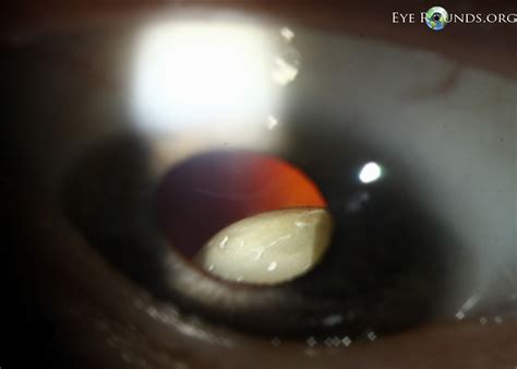 Ectopia Lentis In Marfan Syndrome Captions Profile