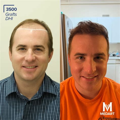 Hair Transplant Cost Per Graft In 2026 Medart Hair