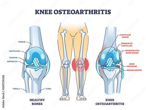 Knee Osteoarthritis Condition With Skeletal Bone Degeneration Outline
